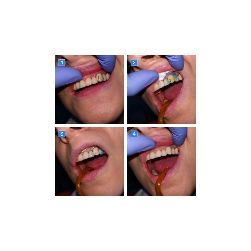 Intraoral Repair Kit - zestaw do napraw wew-ustnych (naprawa porcelany ...