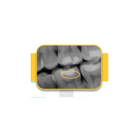 TheraBase Ca - podkład uwalniający wapń z rodziny THERA od BISCO - Nowość