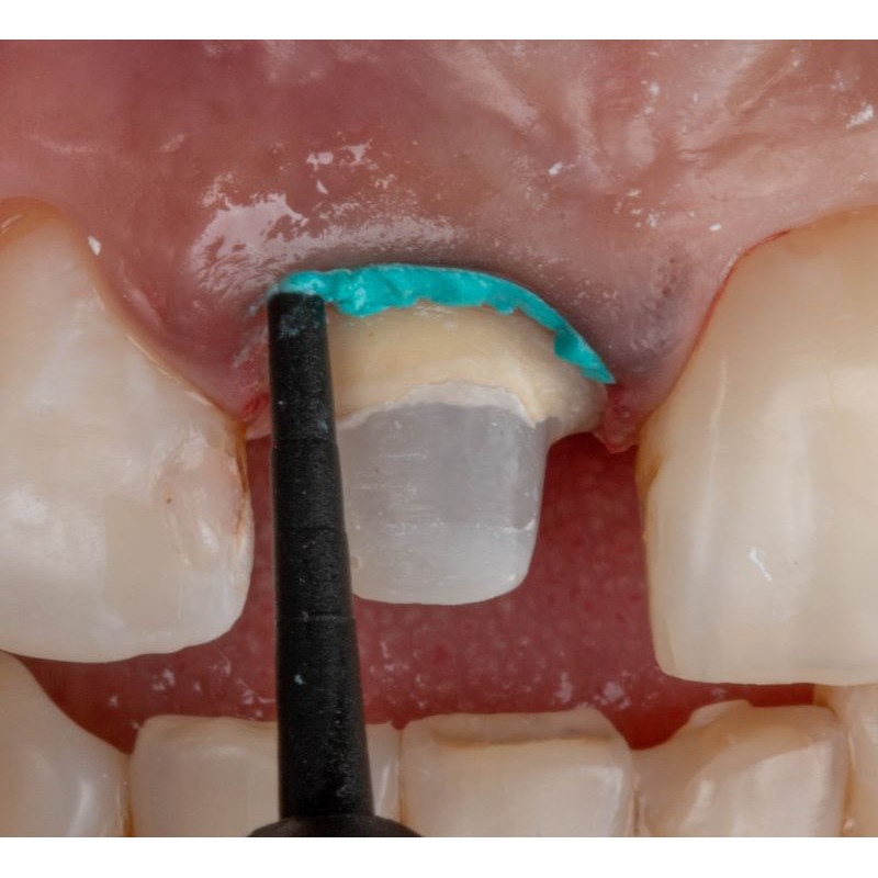 Retraction Paste - pasta retrakcyjna 25 x 0,3g - VOCO