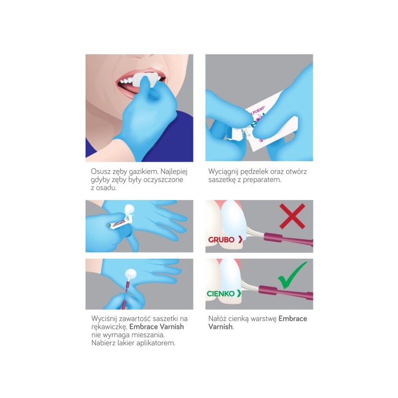 Embrace Varnish 5% - Varnish, lakier do fluoryzacji, remineralizacji ...